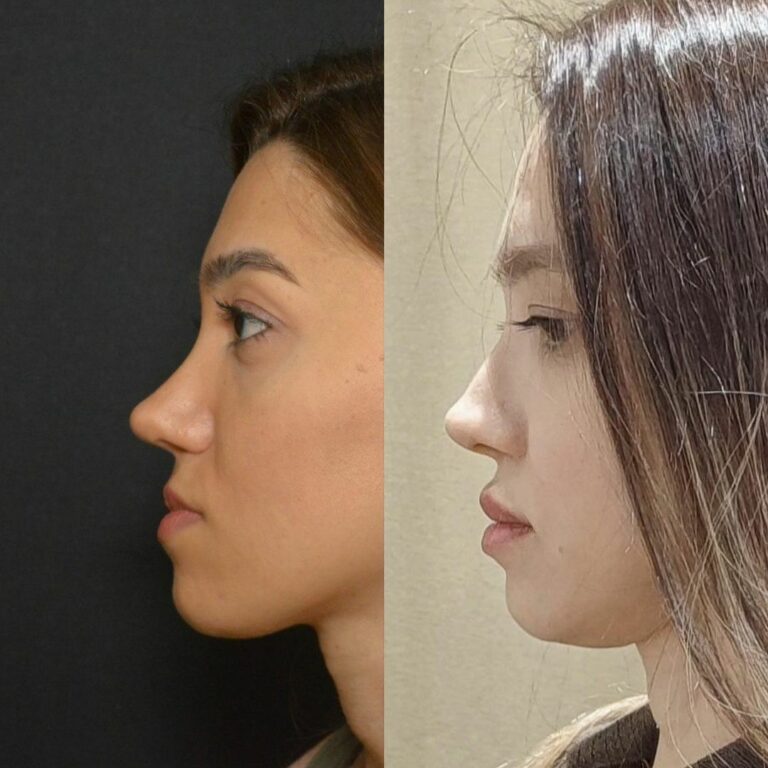 Rhinoplasty (Nose Job) in Istanbul, Turkey - Op. Dr. Alev Camcıoğlu