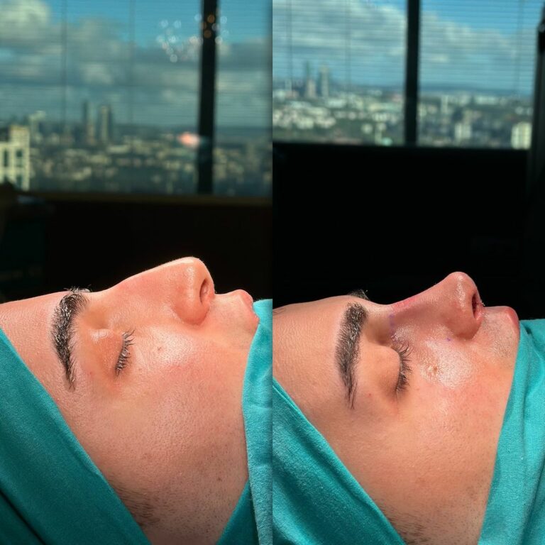 Rhinoplasty (Nose Job) in Istanbul, Turkey - Op. Dr. Alev Camcıoğlu