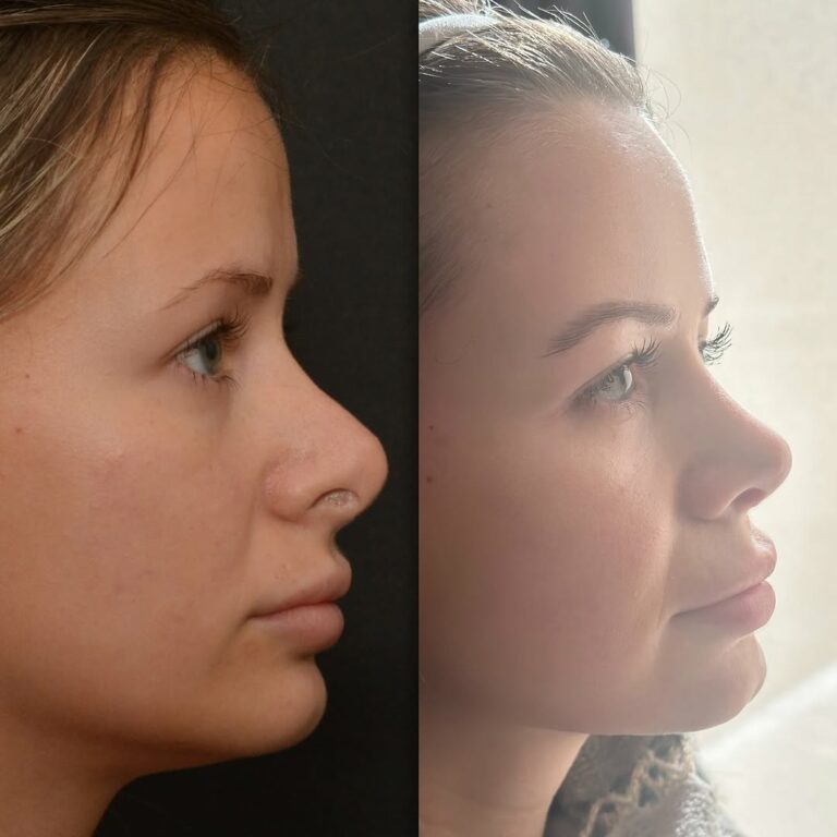 Rhinoplasty (Nose Job) in Istanbul, Turkey - Op. Dr. Alev Camcıoğlu