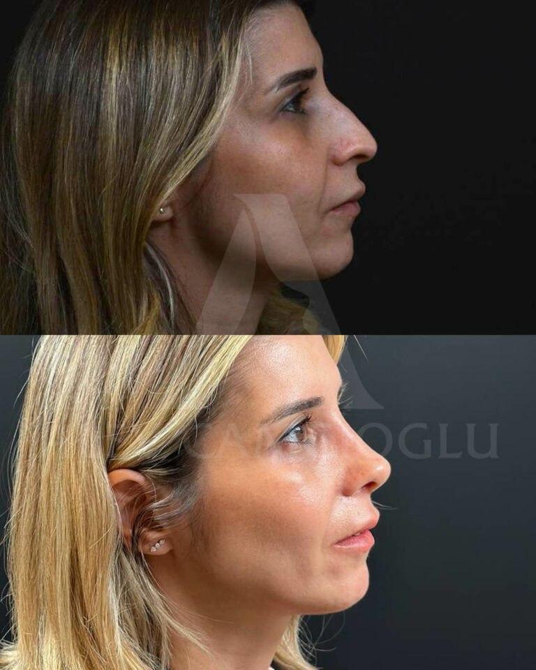 Rhinoplasty (Nose Job) in Istanbul, Turkey - Op. Dr. Alev Camcıoğlu