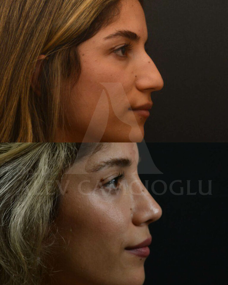 Rhinoplasty (Nose Job) in Istanbul, Turkey - Op. Dr. Alev Camcıoğlu