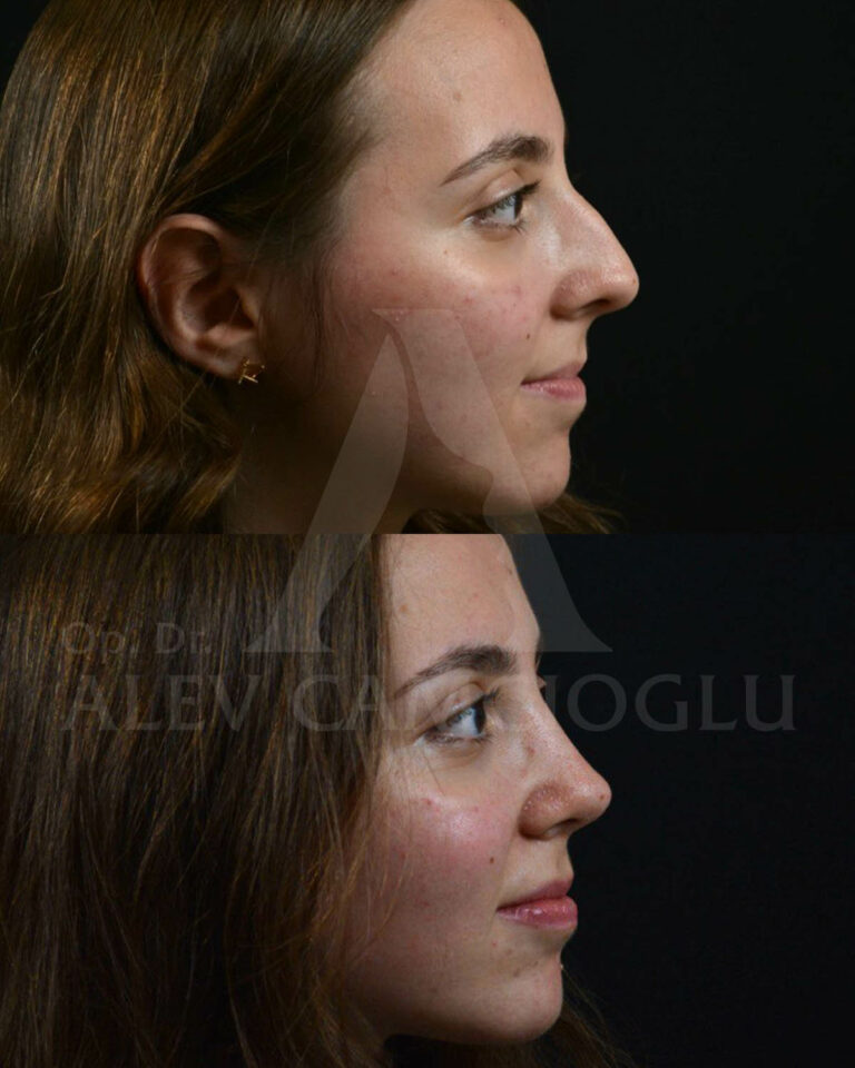 Rhinoplasty (Nose Job) in Istanbul, Turkey - Op. Dr. Alev Camcıoğlu
