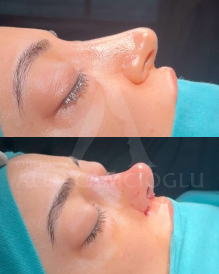 Rhinoplasty (Nose Job) in Istanbul, Turkey - Op. Dr. Alev Camcıoğlu