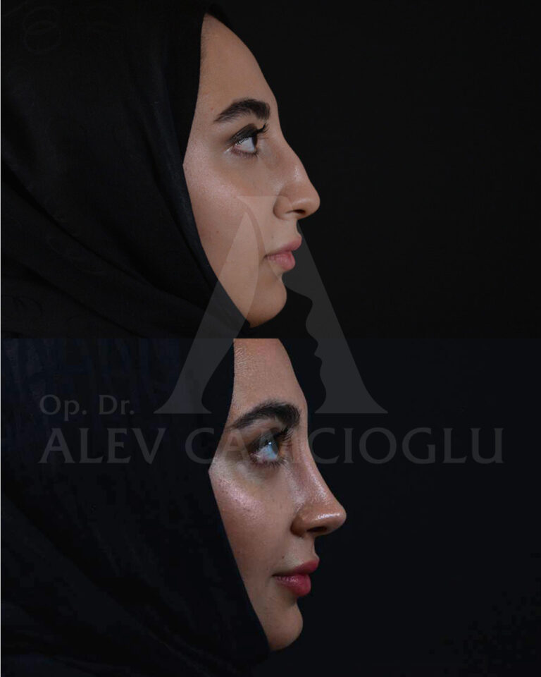 Rhinoplasty (Nose Job) in Istanbul, Turkey - Op. Dr. Alev Camcıoğlu