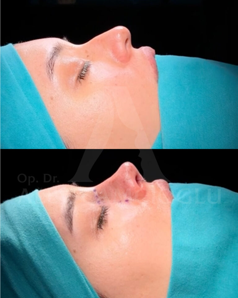 Rhinoplasty (Nose Job) in Istanbul, Turkey - Op. Dr. Alev Camcıoğlu
